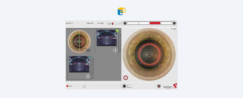 CLEAR LASIK - Eyeonce Eye Clinic