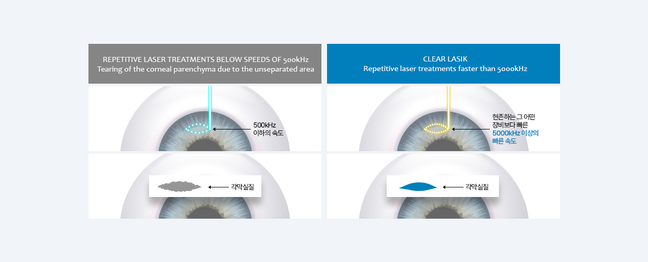 CLEAR LASIK - Eyeonce Eye Clinic