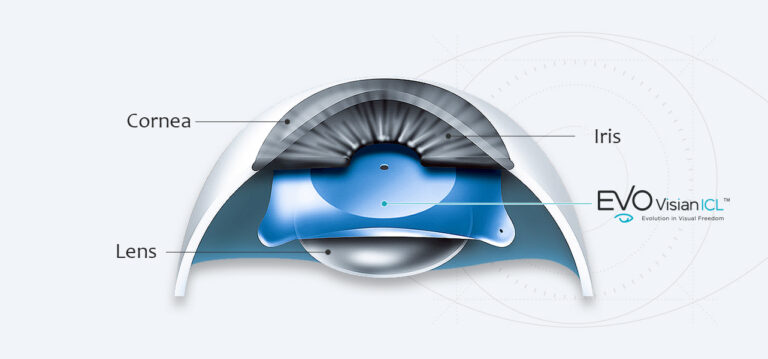 Implantation Surgery - Eyeonce Eye Clinic