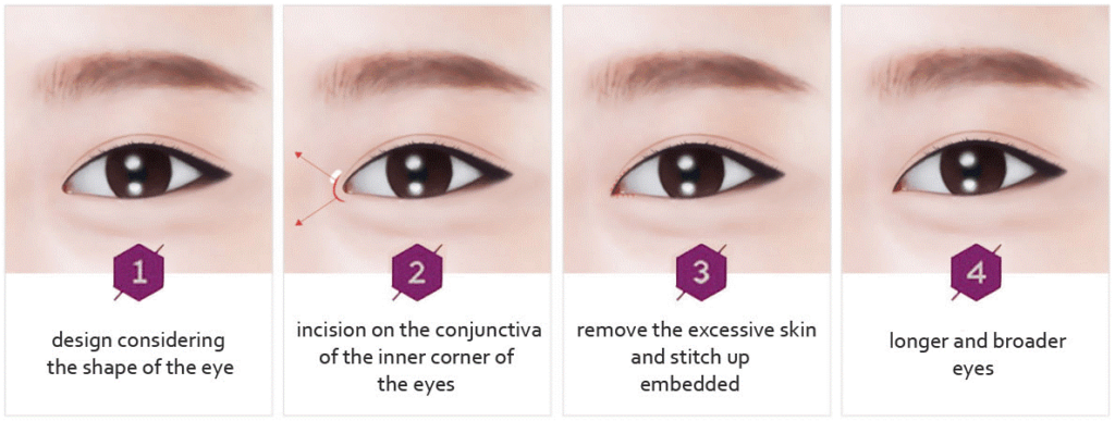EYE SURGERY - Eyeonce Eye Clinic