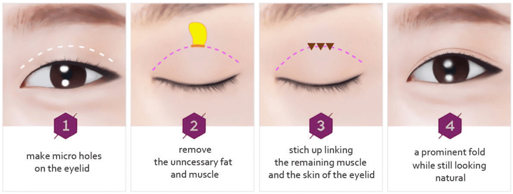 EYE SURGERY - Eyeonce Eye Clinic