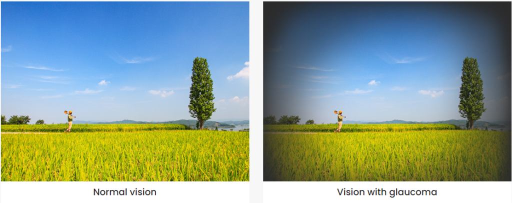 GLAUCOMA AND THE IMPORTANCE OF VISUAL FIELD TESTING FOR ACCURATE ...