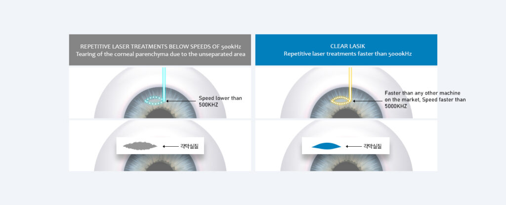 CLEAR LASIK - Eyeonce Eye Clinic