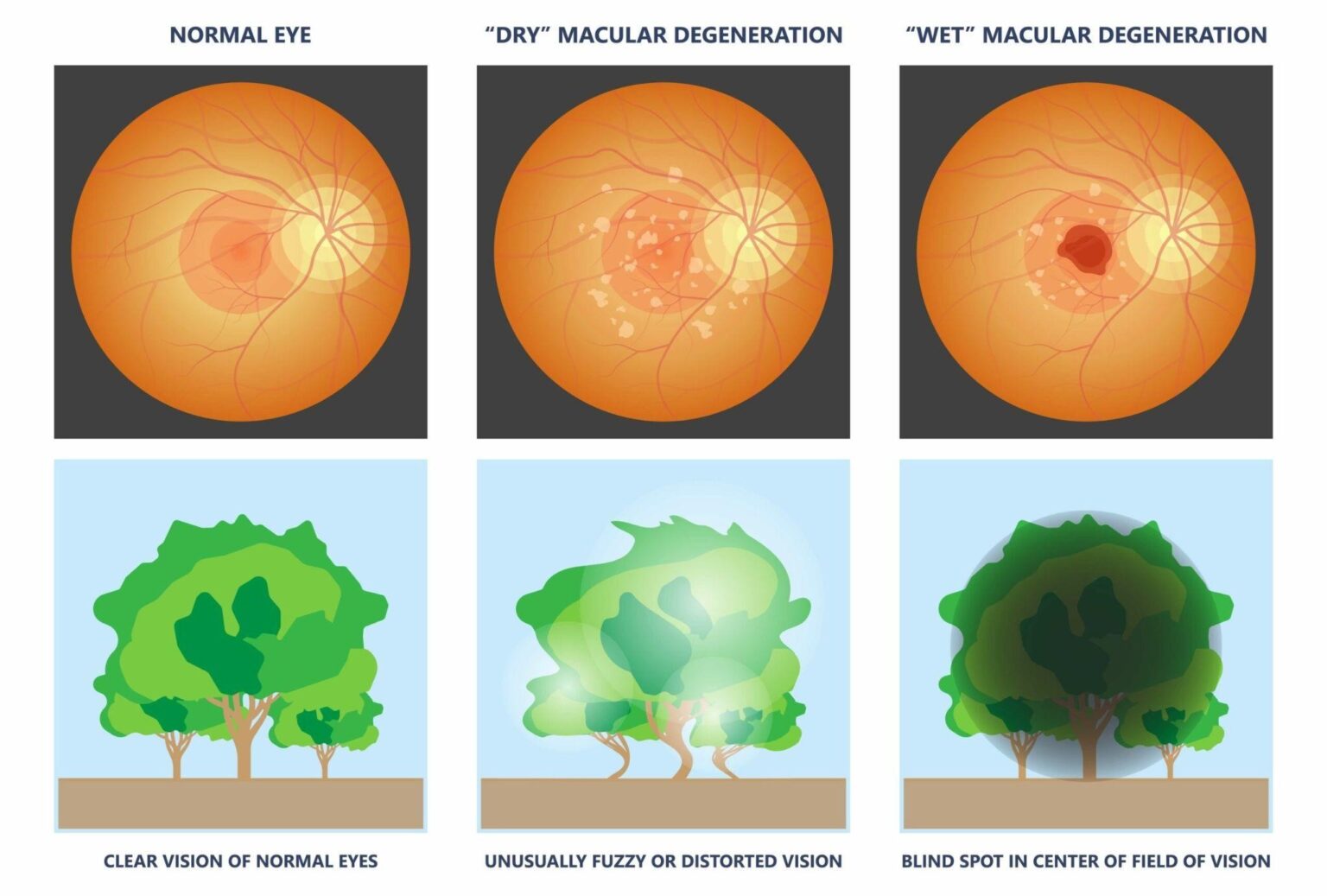 Macular Degeneration Treatment Options and Specialists - Eyeonce Eye Clinic