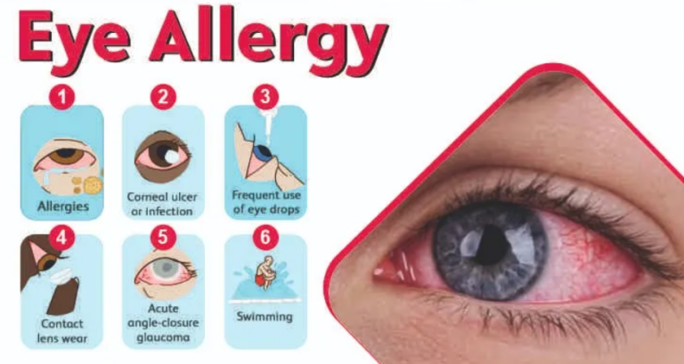 Eye Allergy and Its Impact on Vision: What You Need to Know - Eyeonce ...