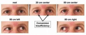 Convergence Insufficiency (CI): Identifying Causes and Treatments ...