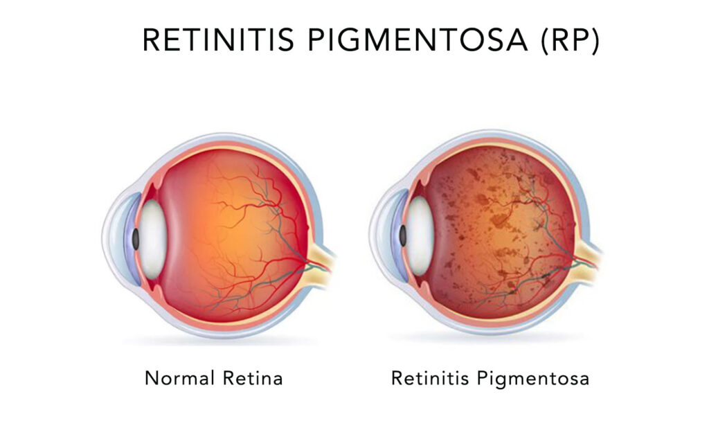 Retinitis Pigmentosa Symptoms: What to Look Out for - Eyeonce Eye Clinic